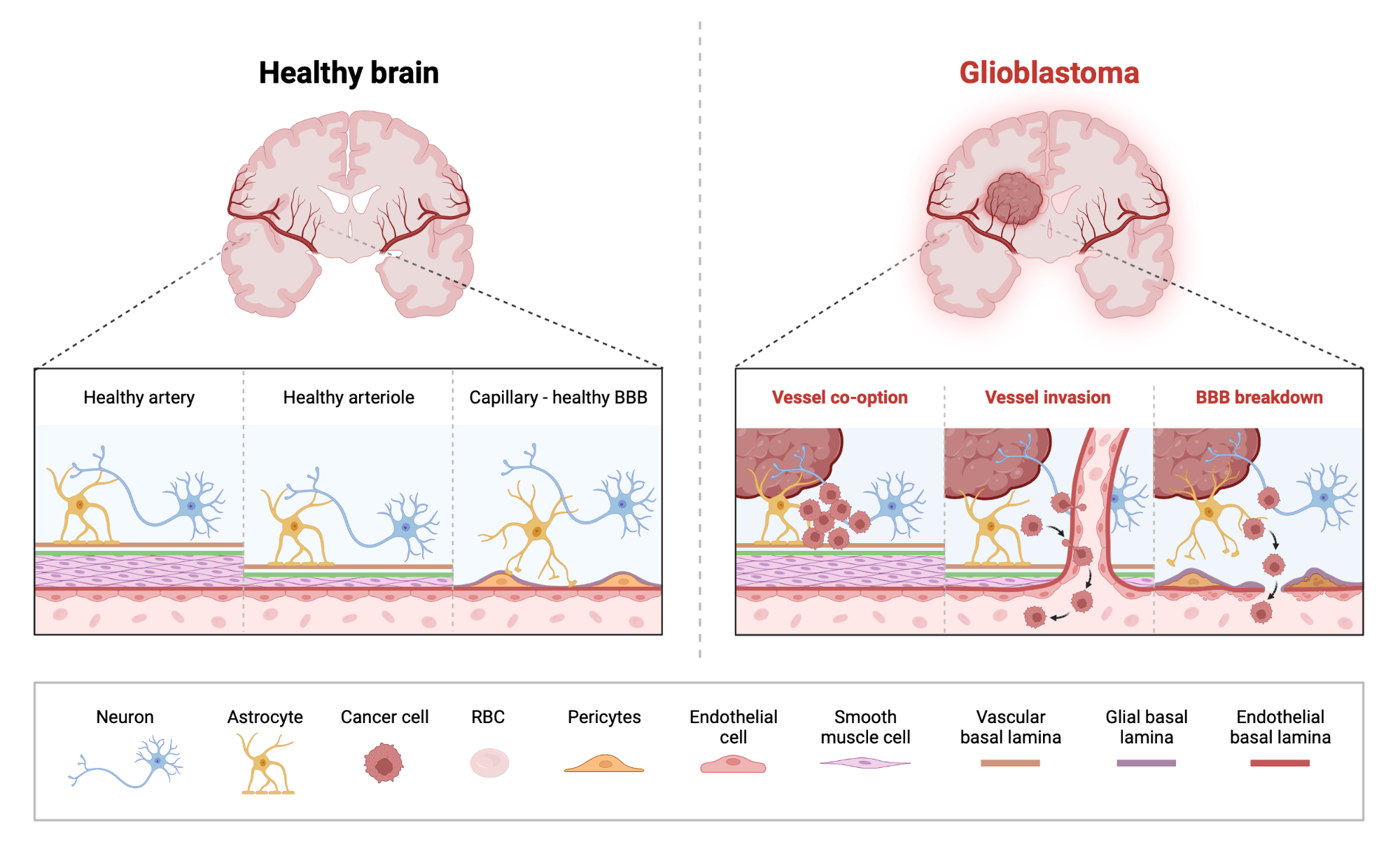Healthy Brain vs. Glioblastoma | BioRender Science Templates