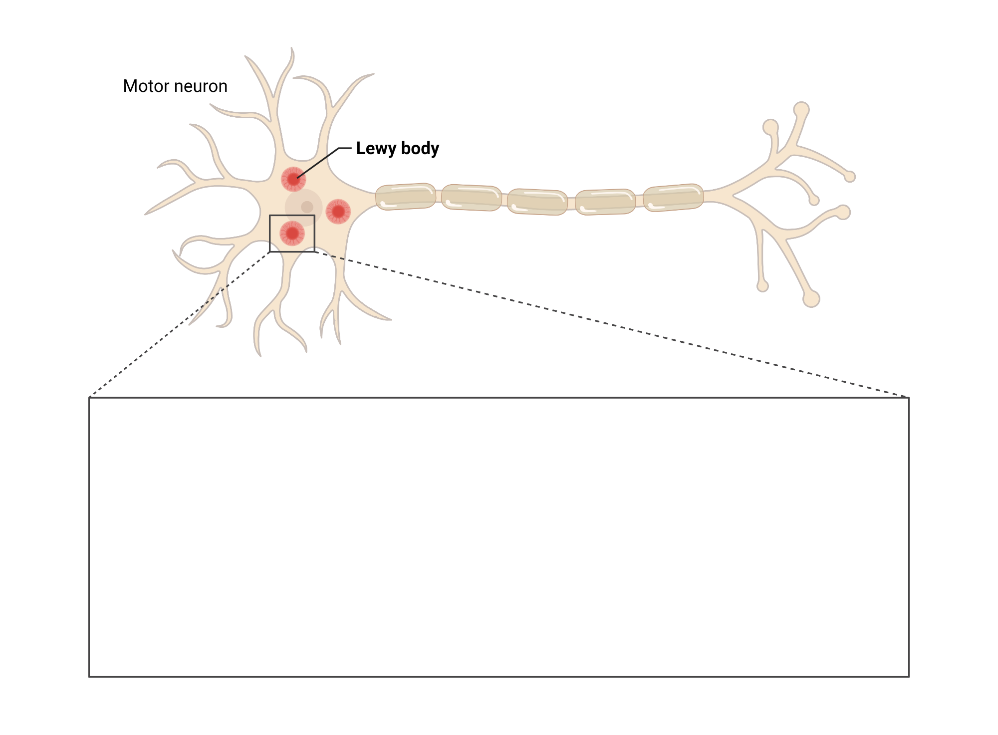 Lewy Body Callout (Layout) | BioRender Science Templates