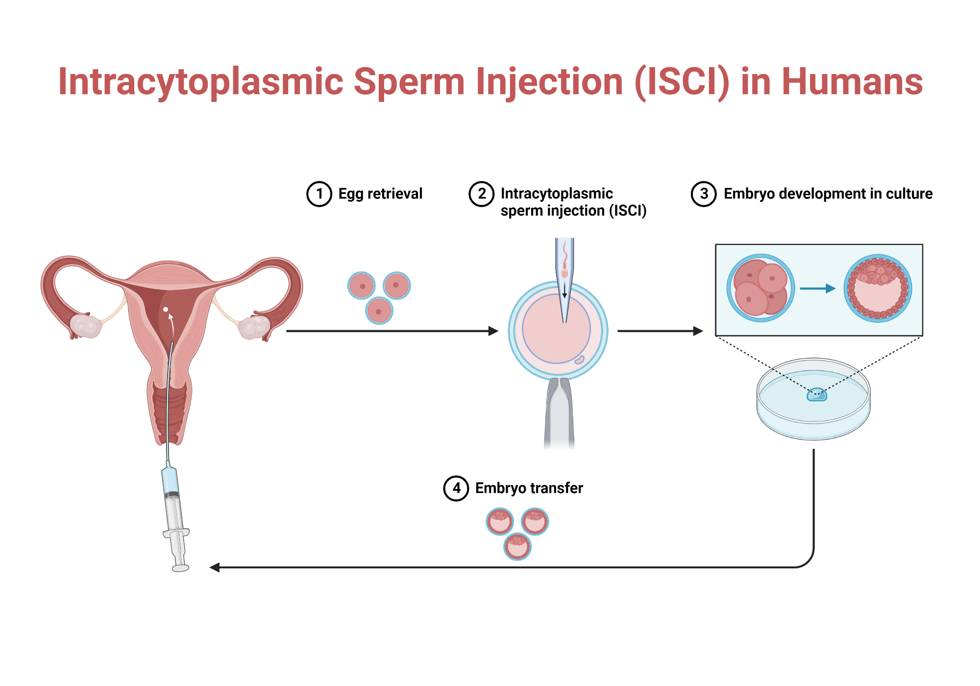 Intracytoplasmic Sperm Injection
