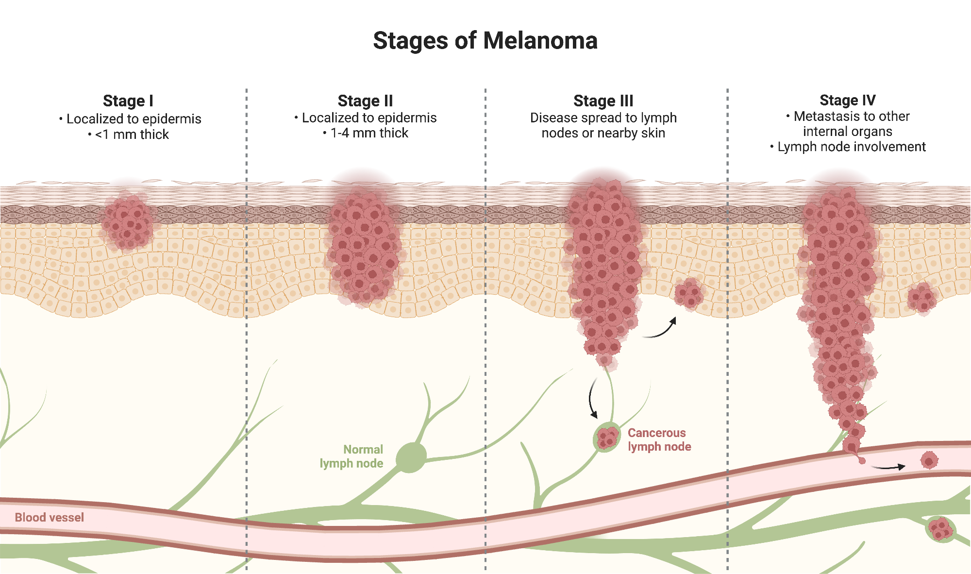 Melanoma Staging BioRender Science Templates Melanoma Staging BioRender Science Templates