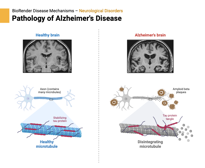 Pathology of Alzheimer's Disease 2 | BioRender Science Templates