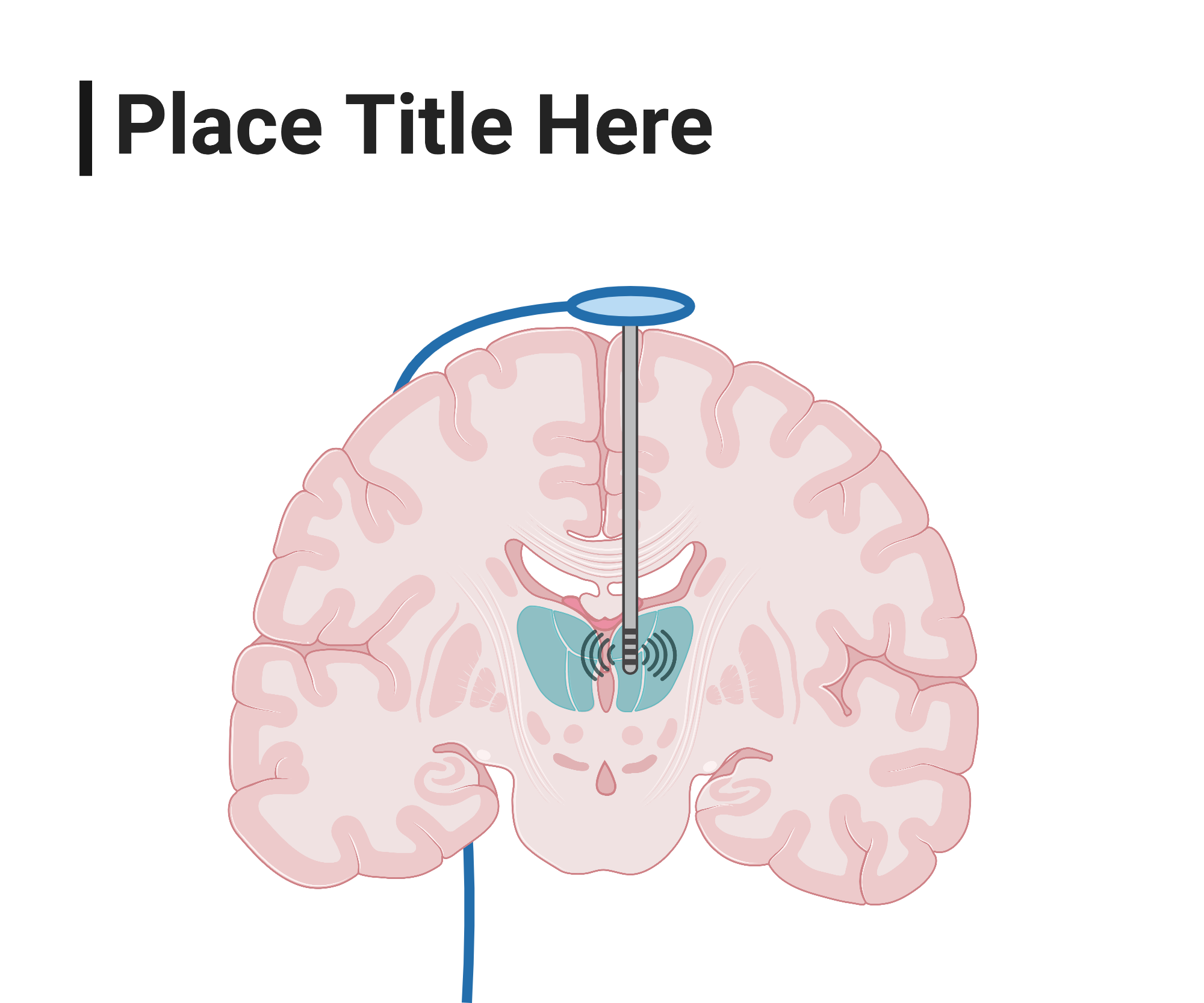 Deep Brain Stimulation (Layout) | BioRender Science Templates
