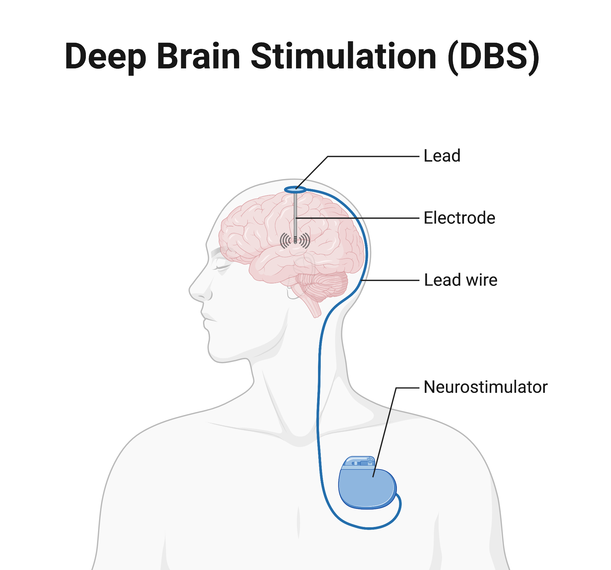 Deep Brain Stimulation (DBS) | BioRender Science Templates Deep Brain Stimulation (DBS) | BioRender Science Templates