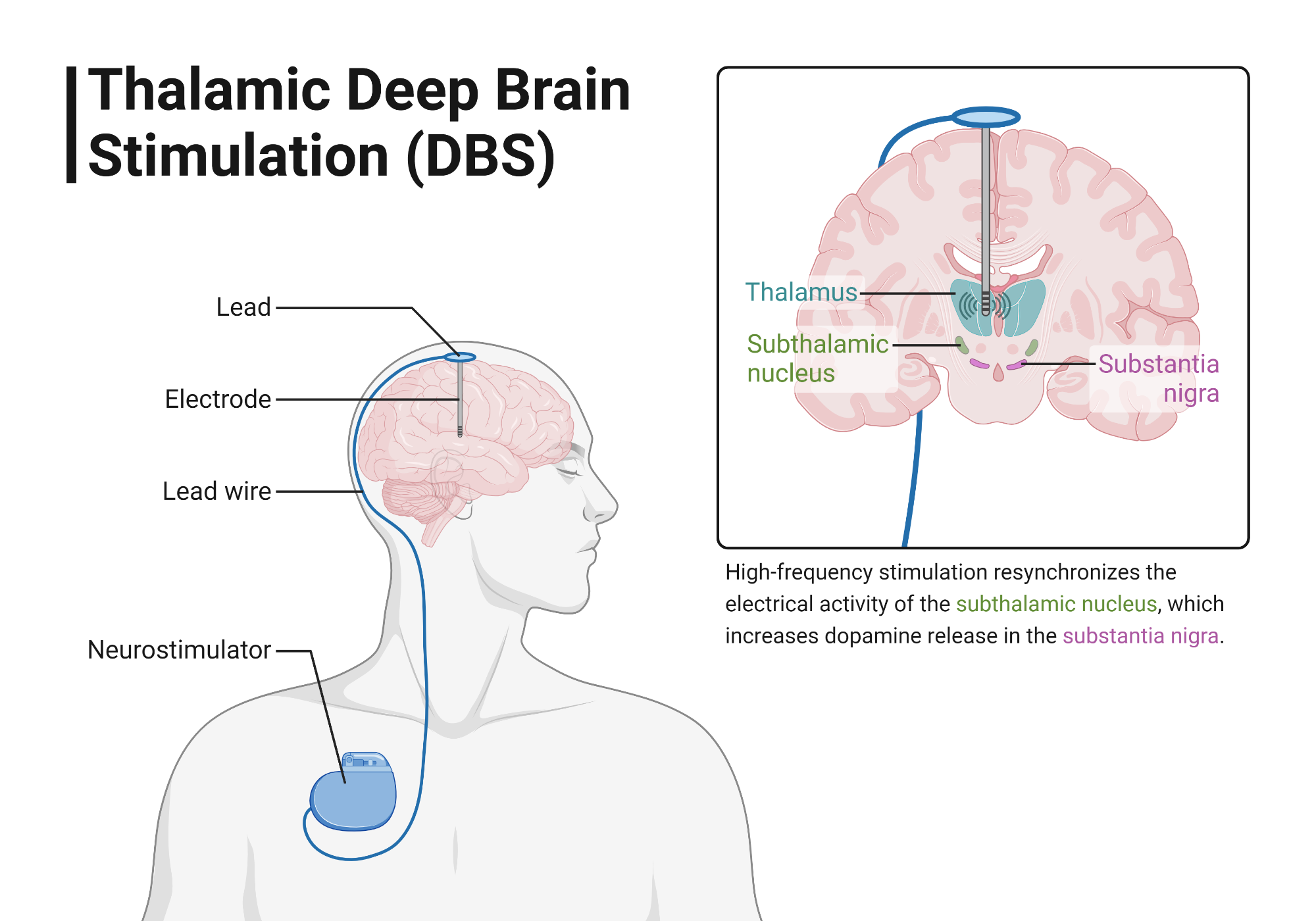 Thalamic Deep Brain Stimulation | BioRender Science Templates