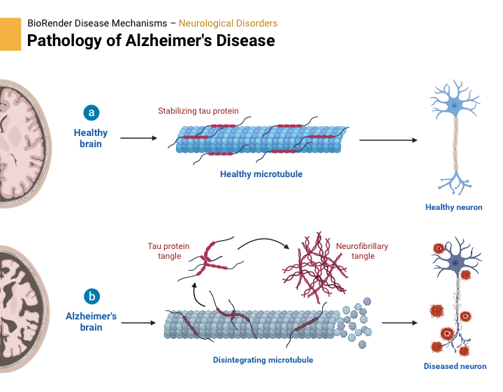 Pathology of Alzheimer's Disease | BioRender Science Templates