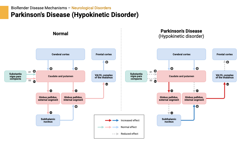 Parkinson's Disease (Hypokinetic Disorder) | BioRender Science Templates