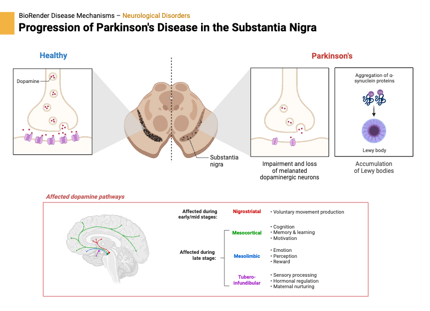 Progression of Parkinson's Disease in the Substantia Nigra | BioRender ...