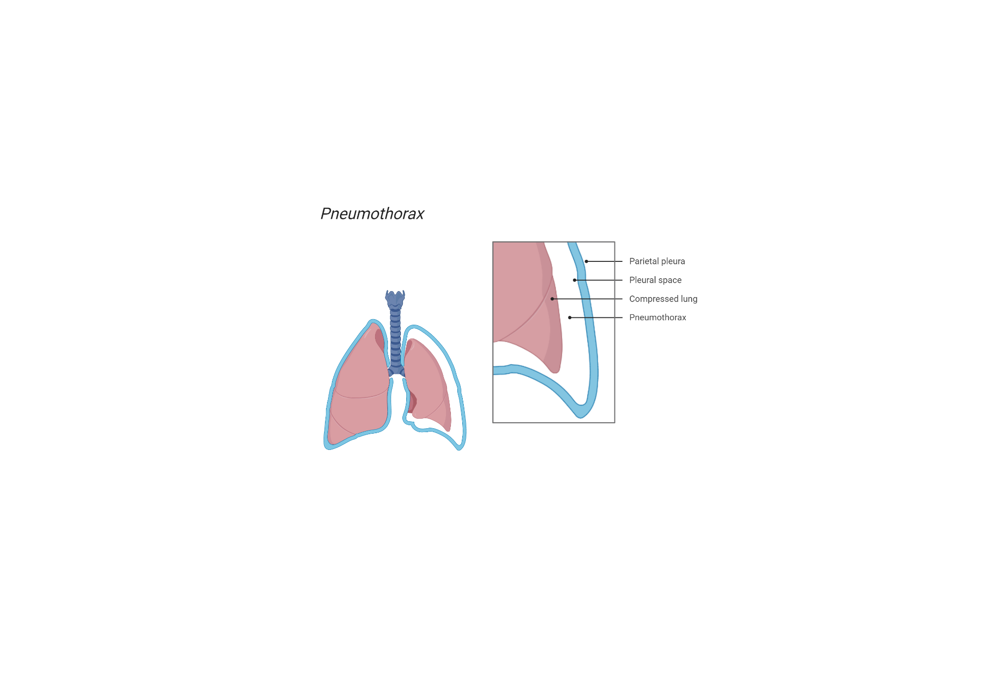 Pneumothorax Model | BioRender Science Templates