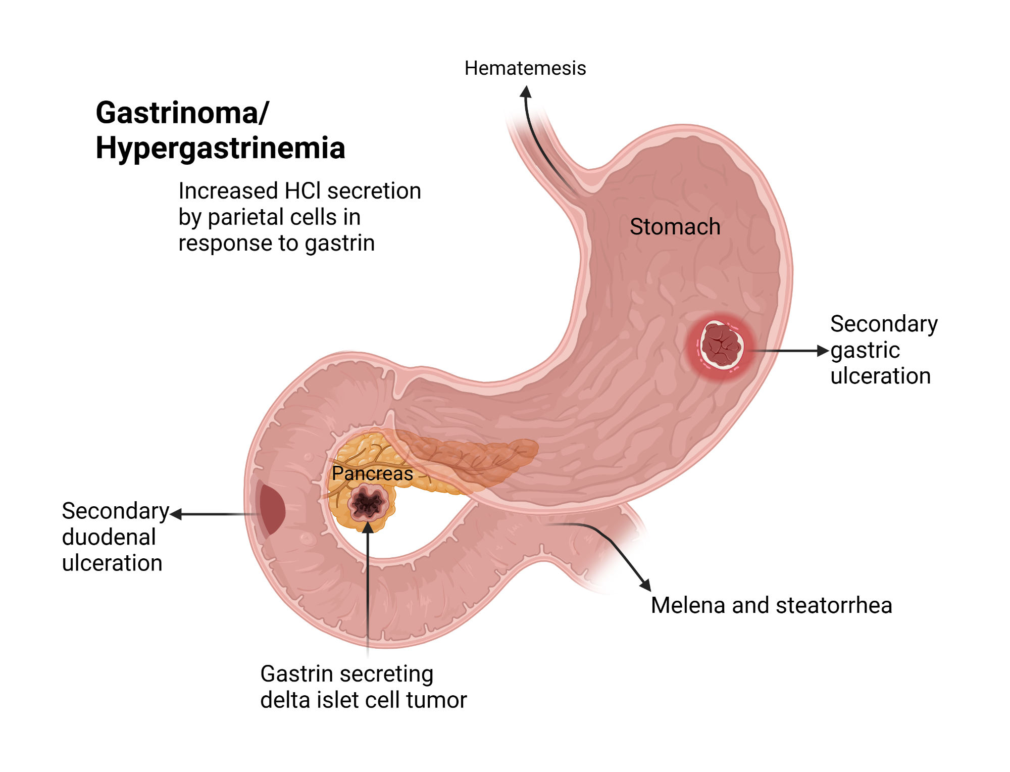 Gastrinoma | BioRender Science Templates