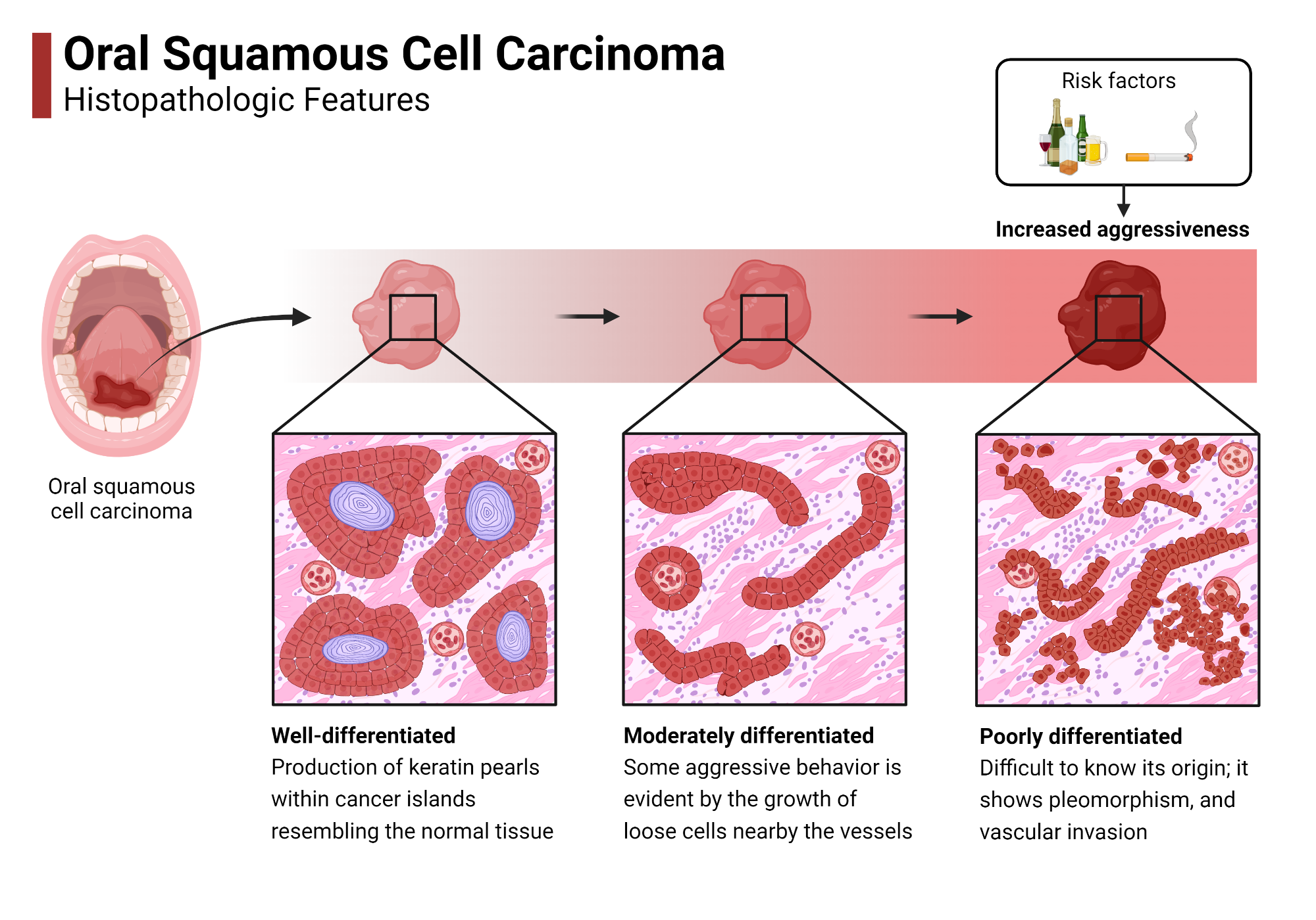 Oral Squamous Cell Carcinoma Histopathologic Features | BioRender ...