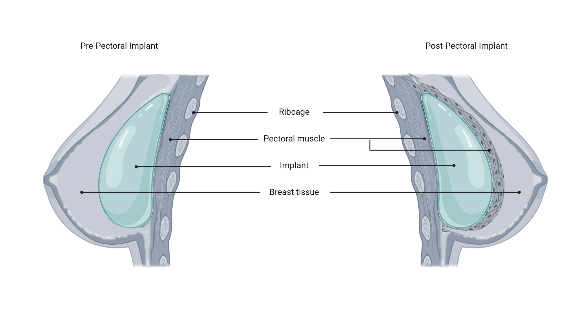 Breast Cancer Surgery Implant Placement | BioRender Science Templates