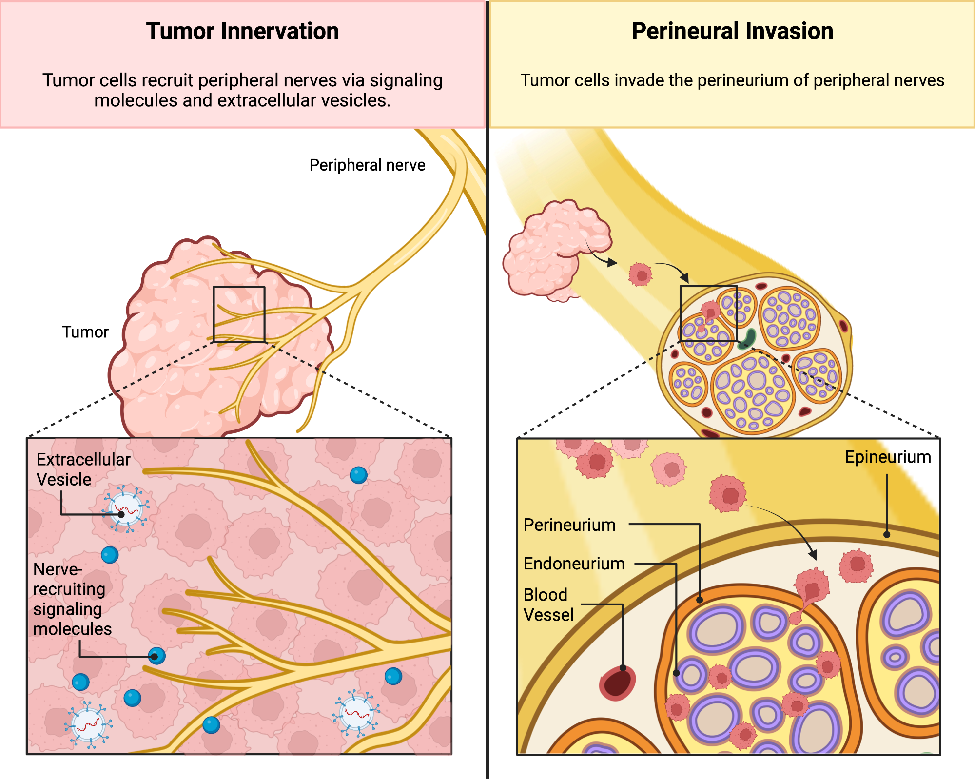 Tumor Innervation vs Perineural Invasion | BioRender Science Templates