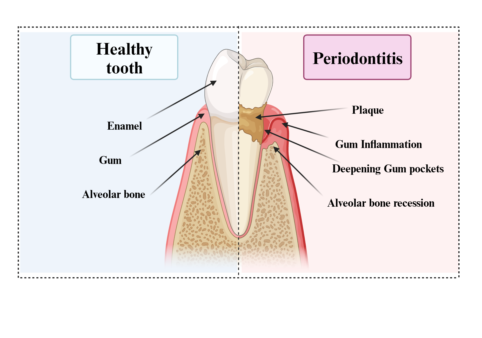 Healthy Vs Periodontitis Tooth | BioRender Science Templates