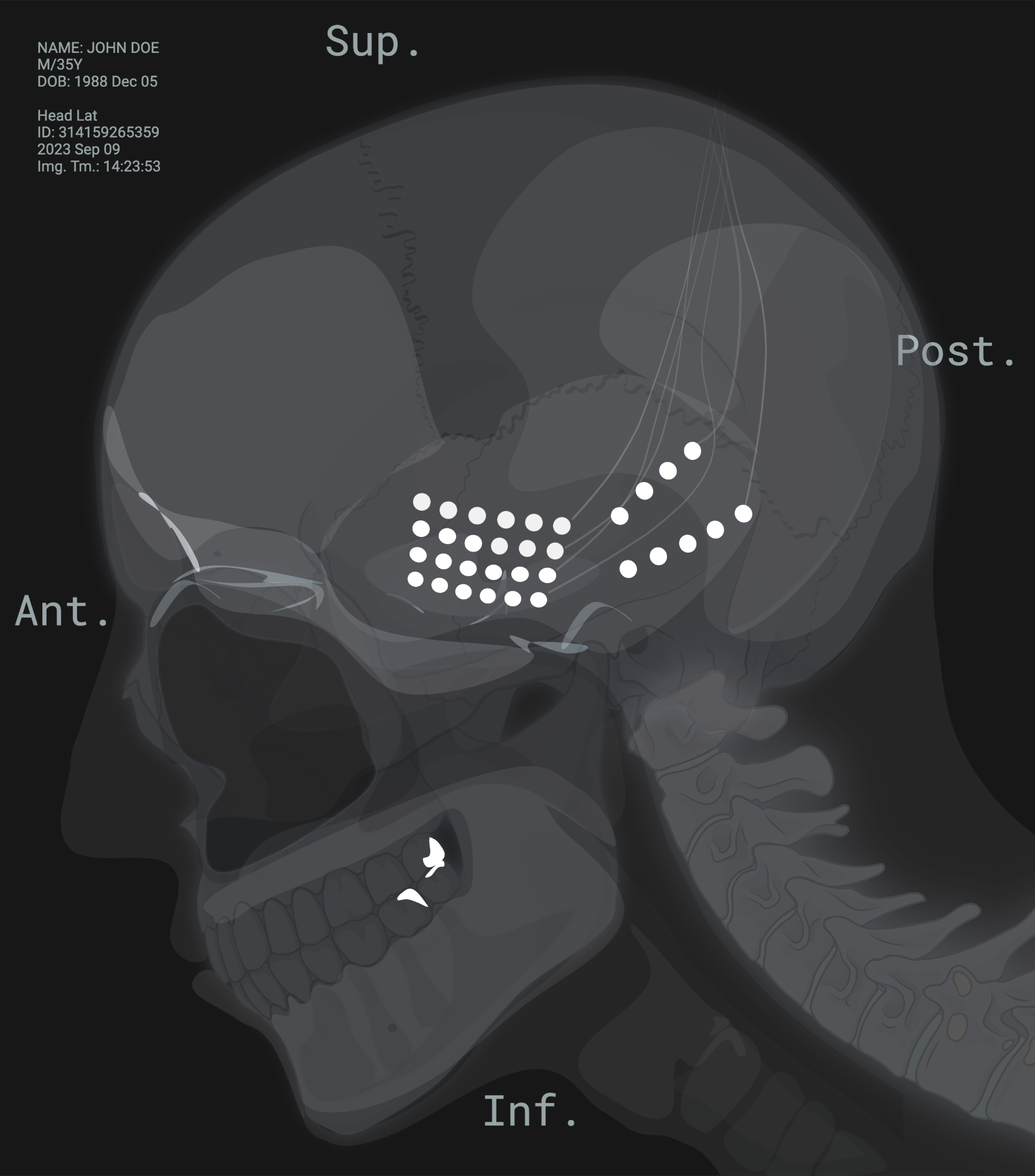 Intracranial Electrodes Biorender Science Templates