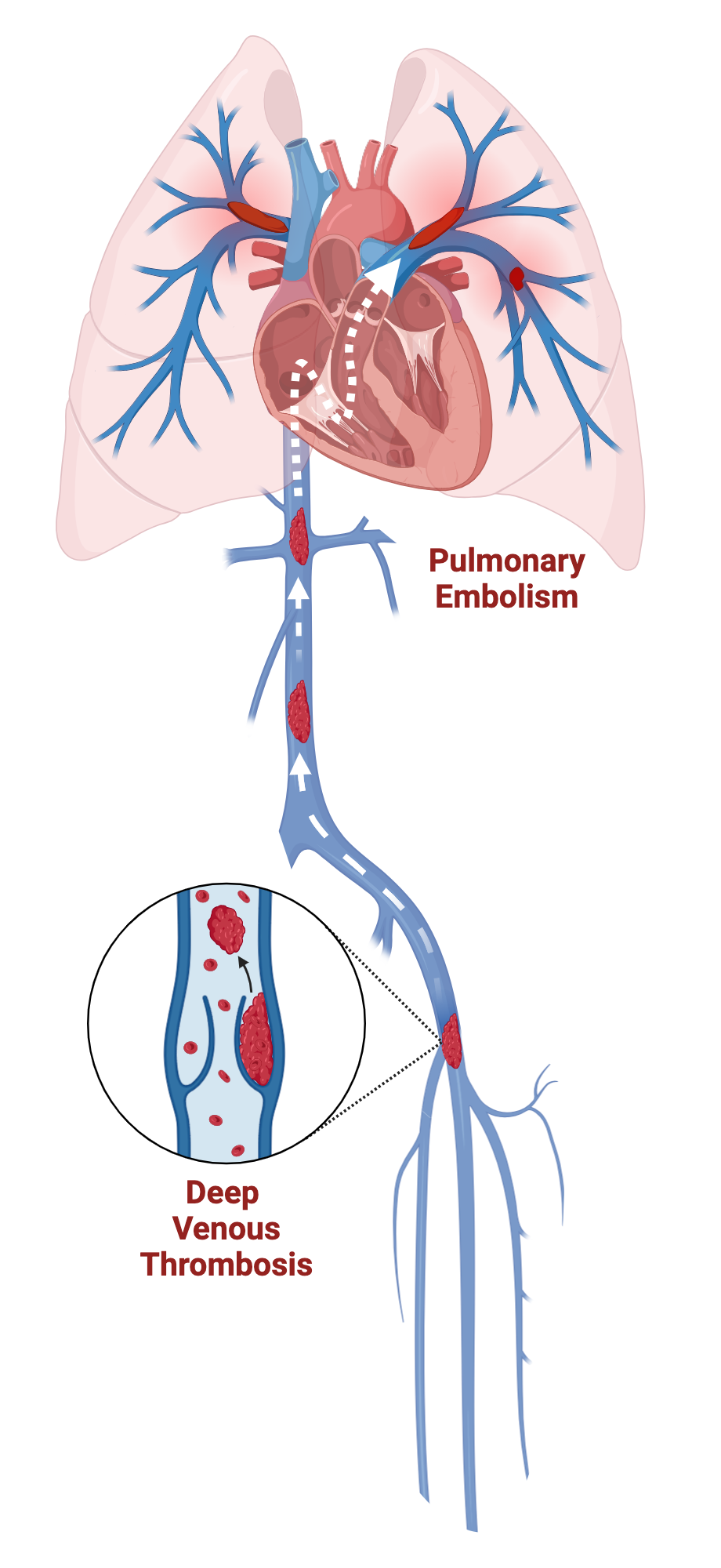 Pulmonary Embolism DVT | BioRender Science Templates