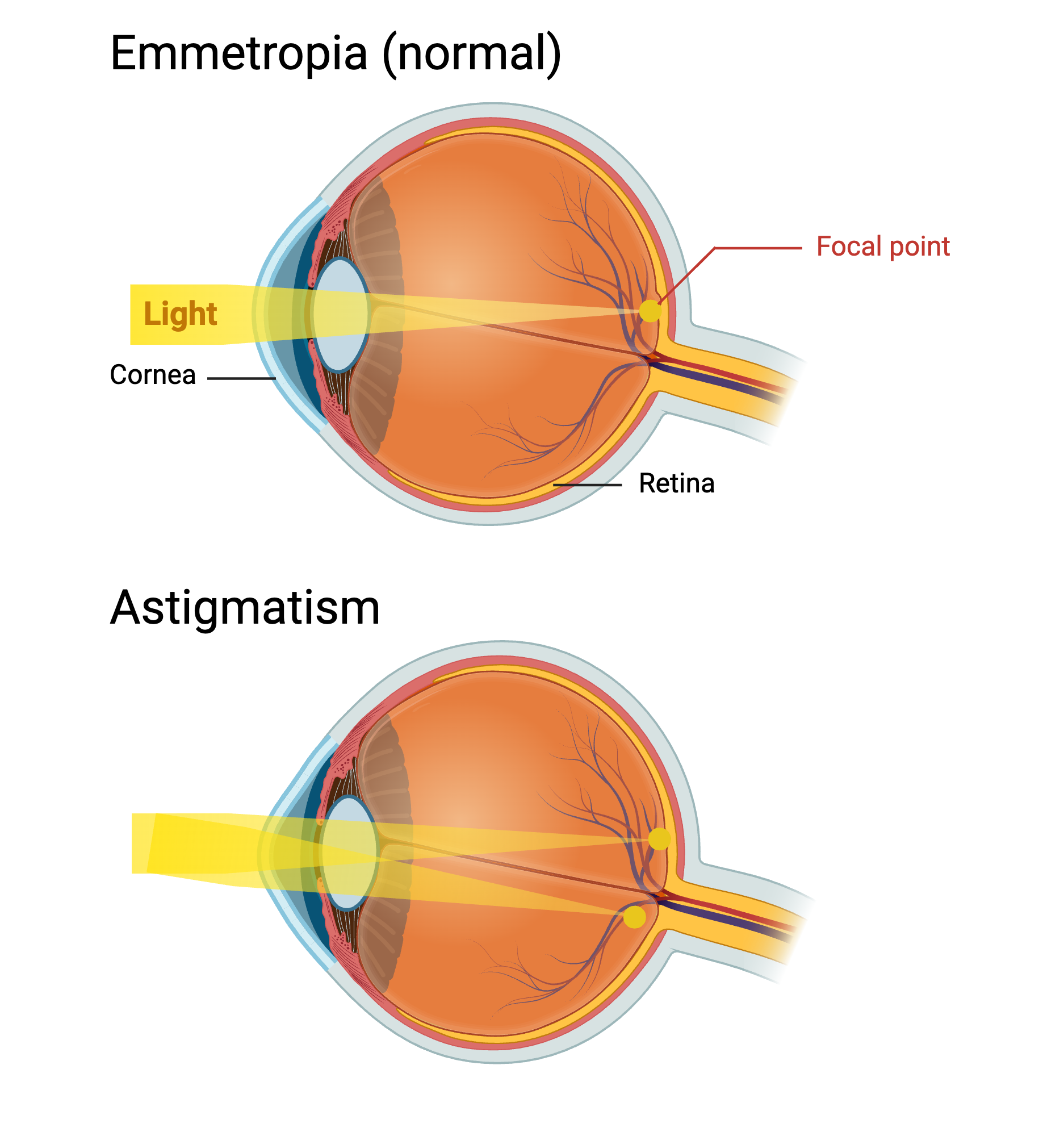 Astigmatism Creates Multiple Focal Points | BioRender Science Templates