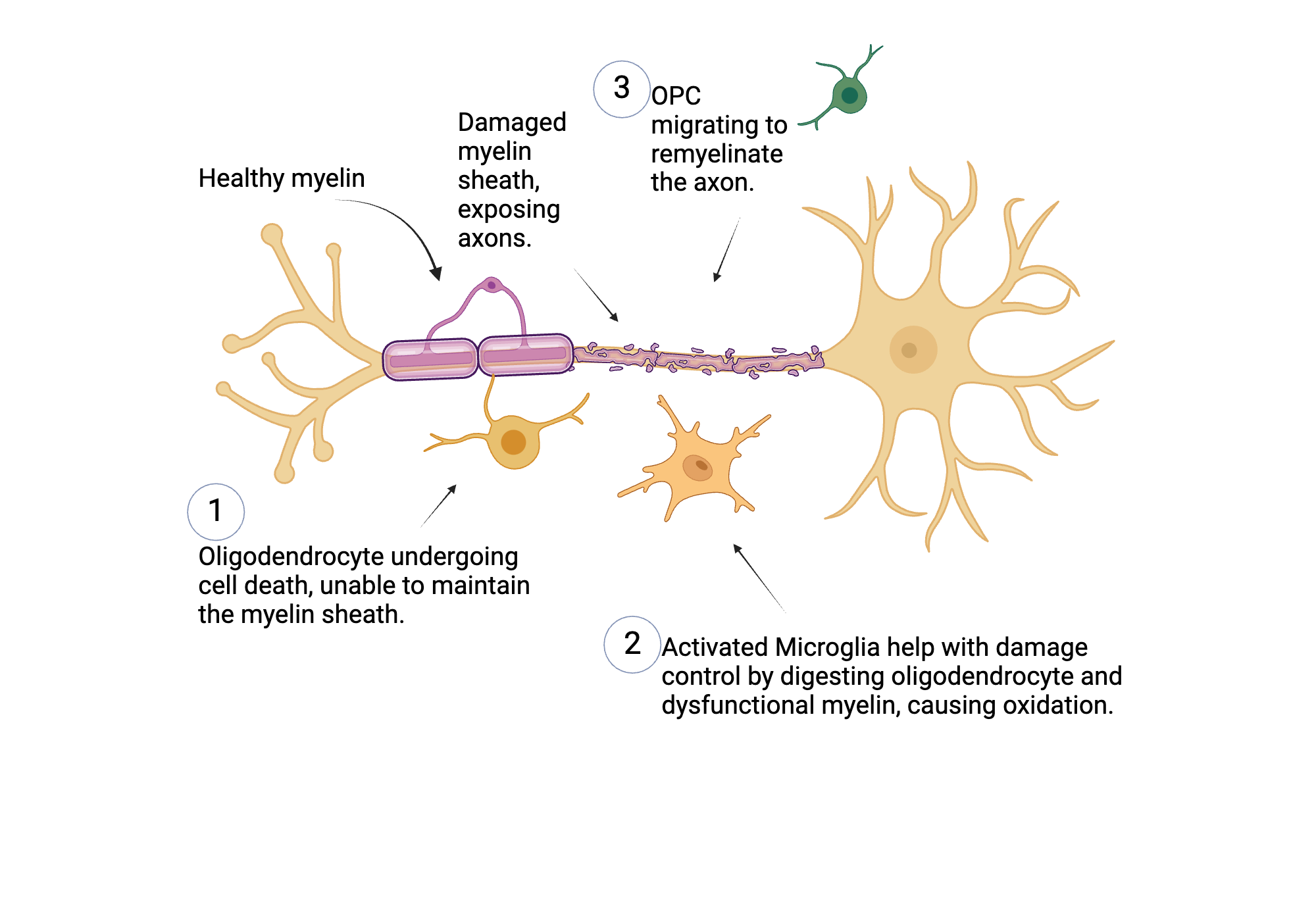 Demyelination and Remyelination of Early MS lesion. | BioRender Science ...