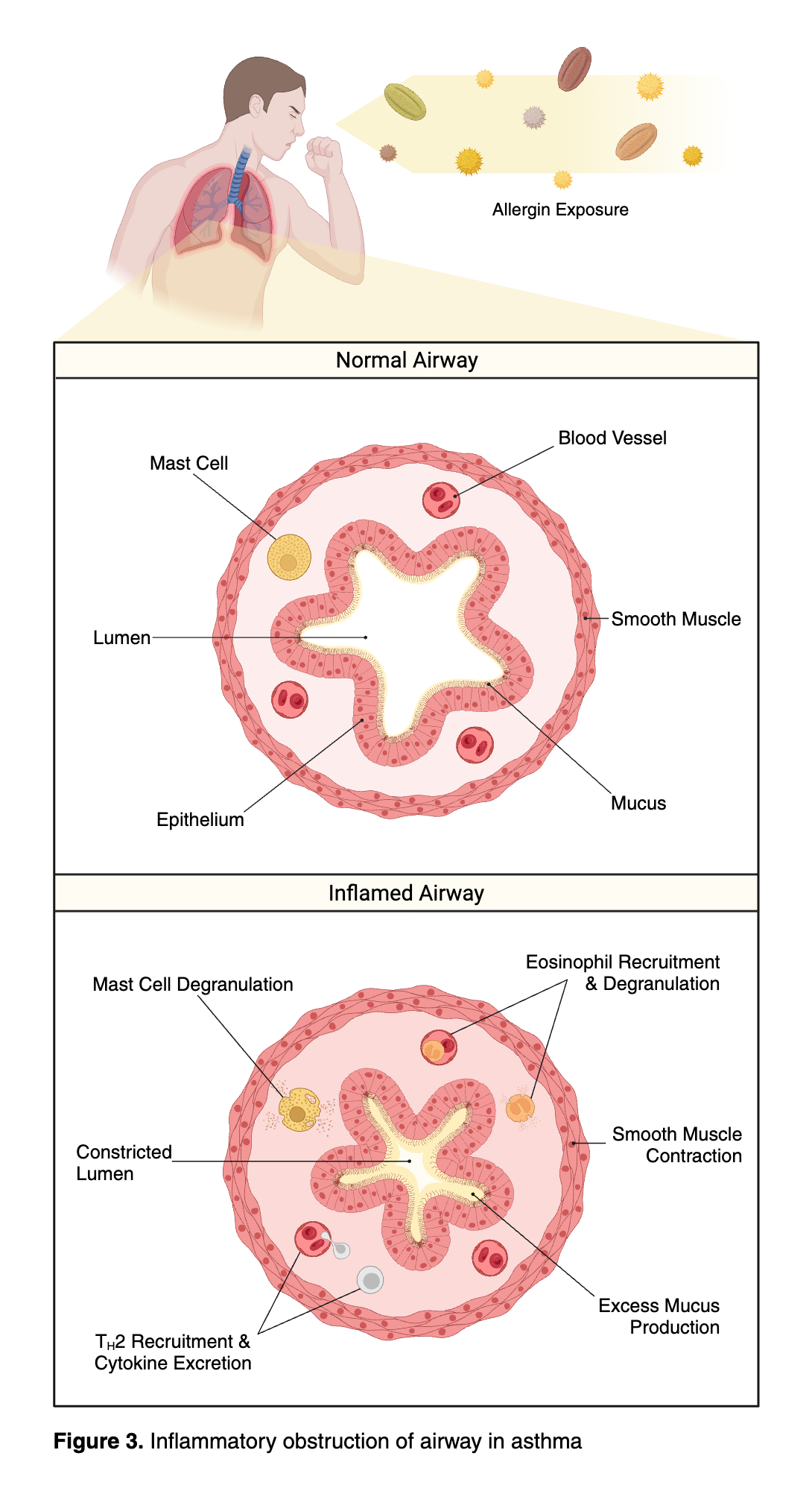 Inflammatory obstruction of airway in asthma | BioRender Science Templates