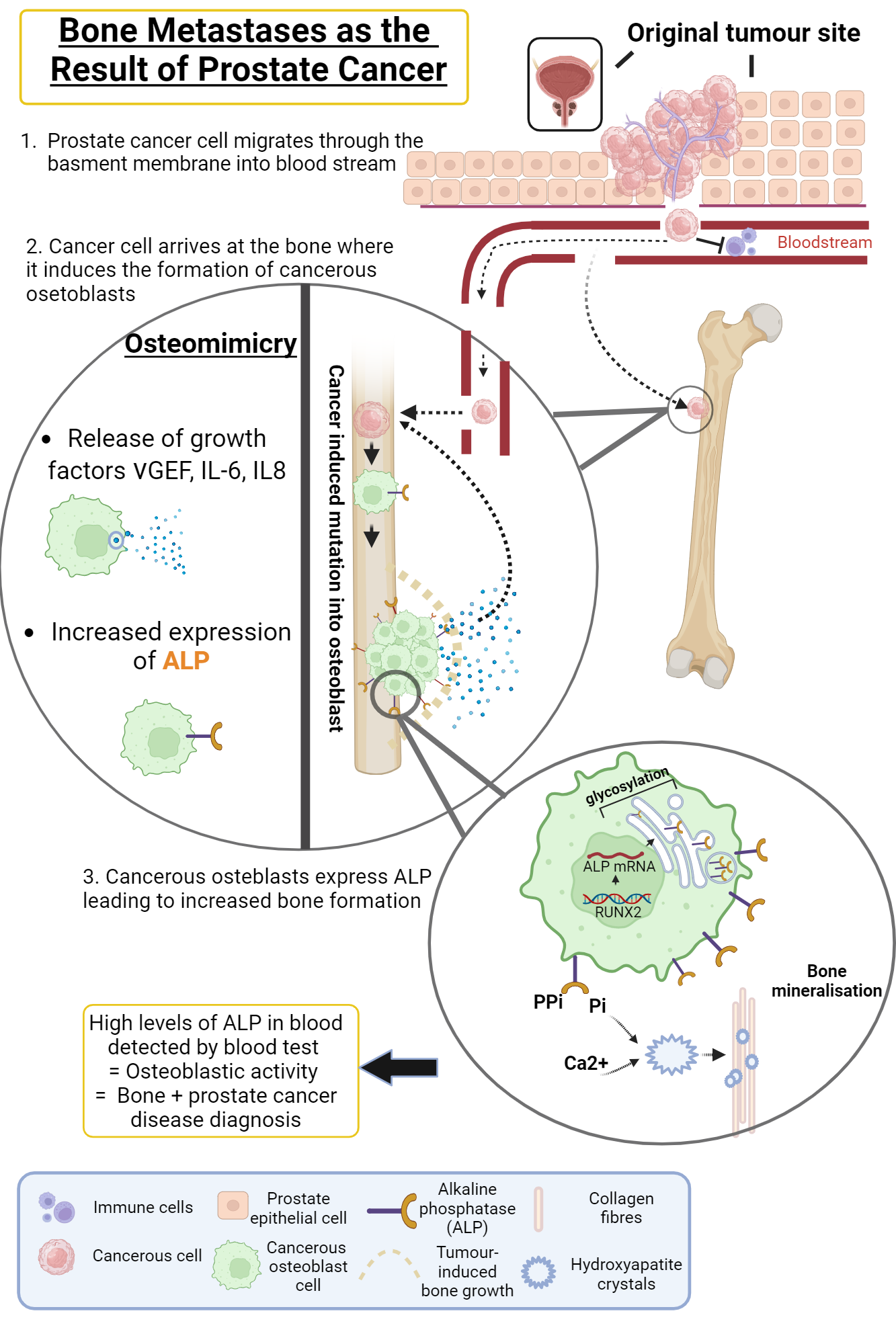Bone Metastases as the Result of Prostate Cancer | BioRender Science ...