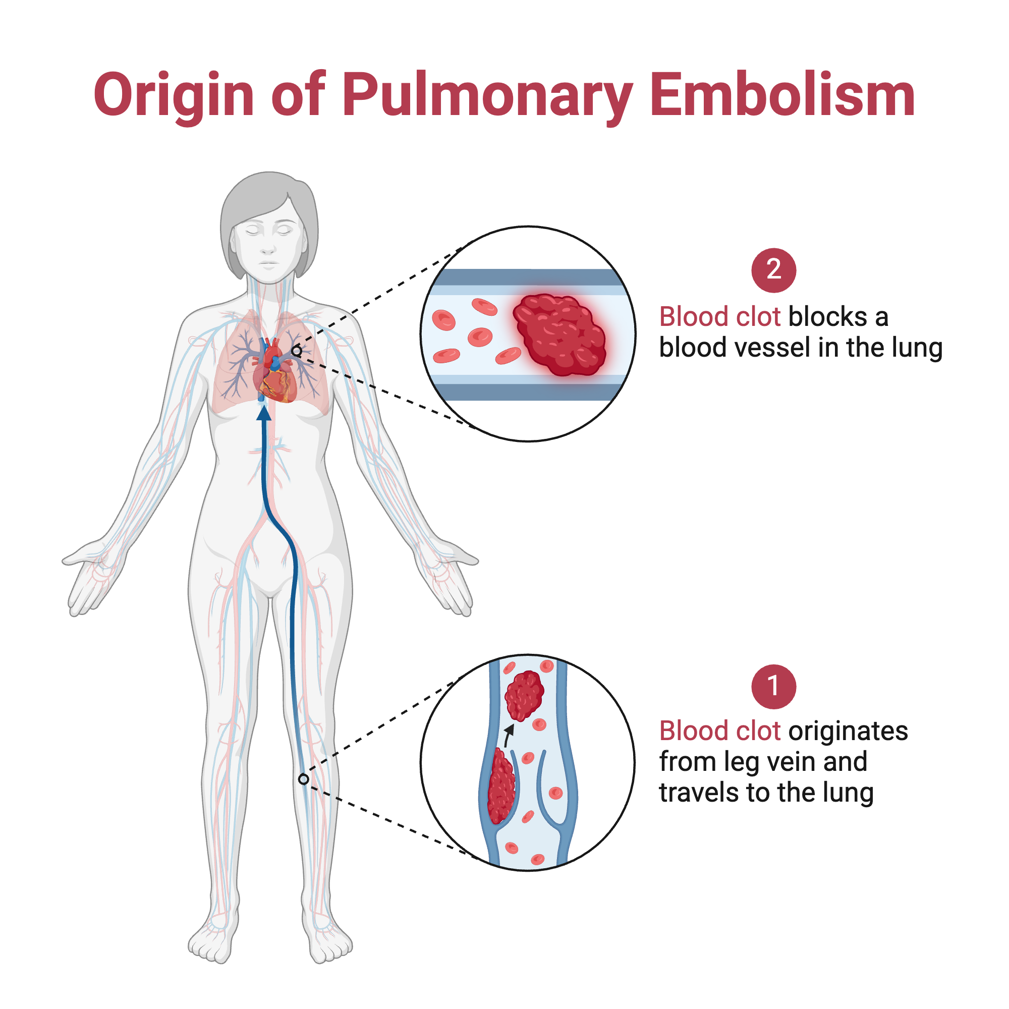 Origin of Pulmonary Embolism | BioRender Science Templates