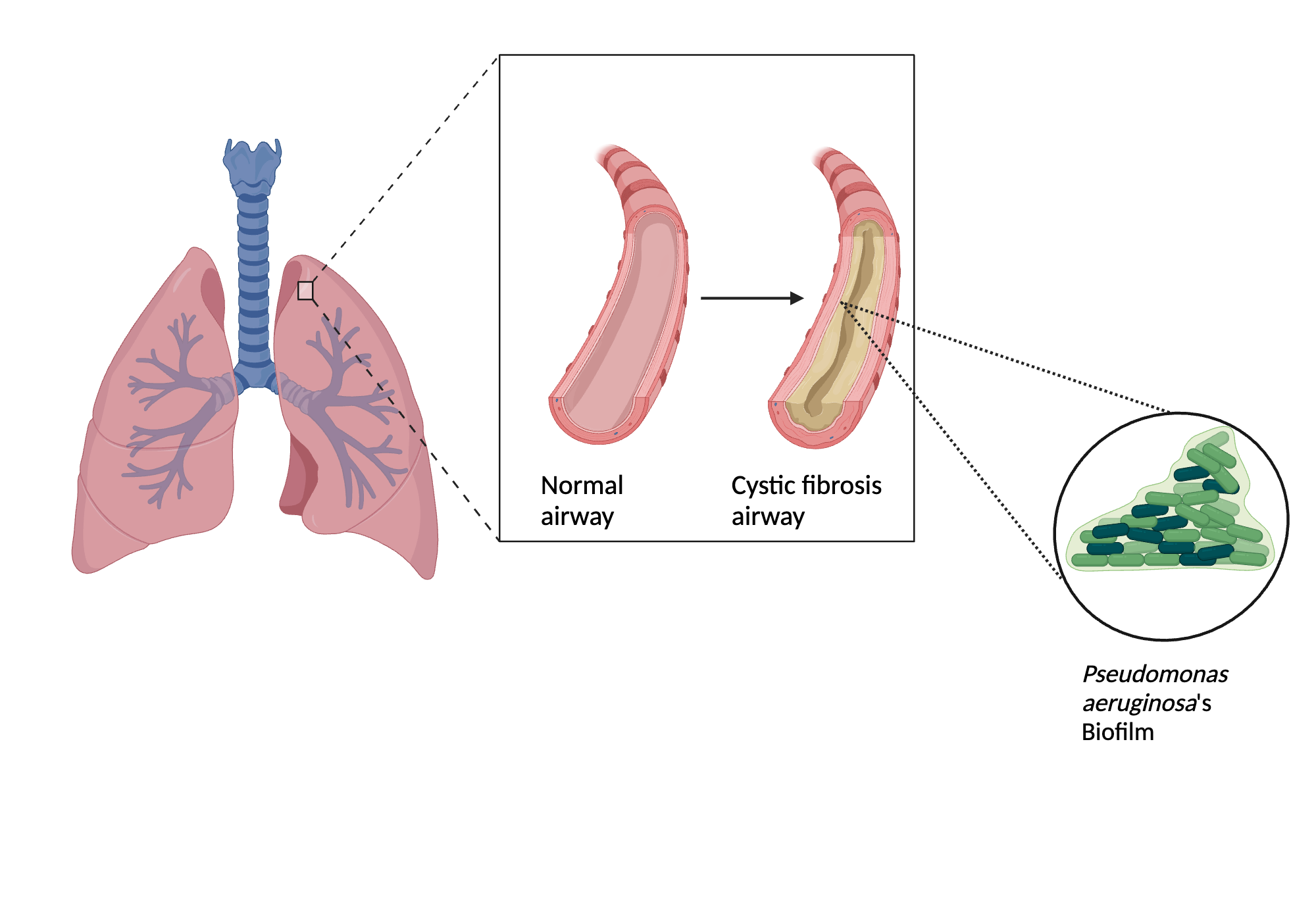 Pseudomonas aeruginosa biofilm in cystic fibrosis patients | BioRender ...