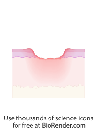 Free Skin epithelium (ulcer) Icons, Symbols & Images | BioRender