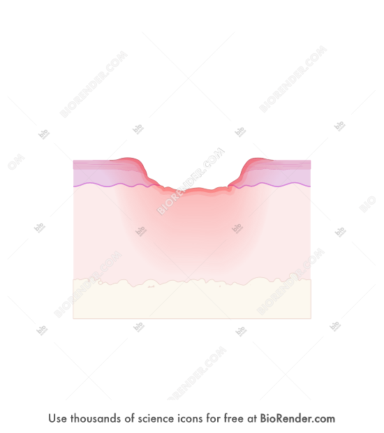 Free Skin epithelium (ulcer) Icons, Symbols & Images | BioRender