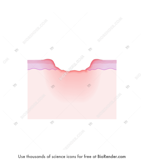 Free Skin epithelium (ulcer, without hypodermis) Icons, Symbols ...