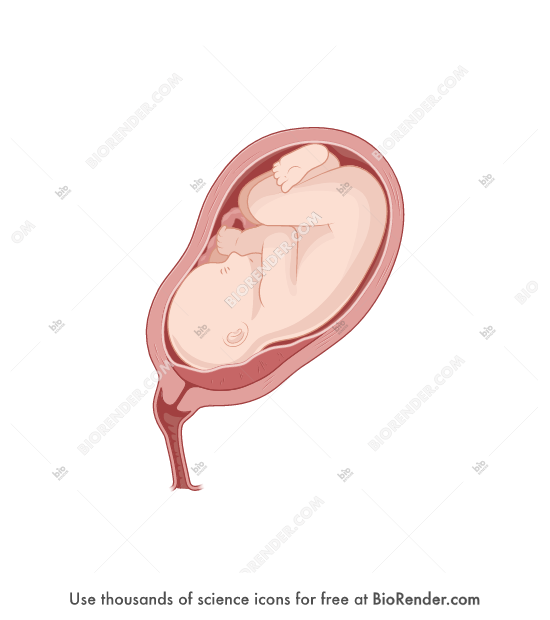 Free Fetus with placenta previa (in utero, third trimester) Icons ...