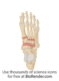 Free Foot bones (dorsal, arthritic, medial midfoot) Icons, Symbols ...