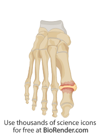 Free Foot bones (anterior, with podagra) Icons, Symbols & Images ...