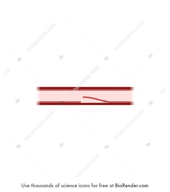 Free Blood vessel (cut, artery dissection, type 1) Icons, Symbols ...
