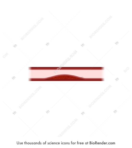 Free Blood vessel (cut, artery dissection, type 2) Icons, Symbols ...