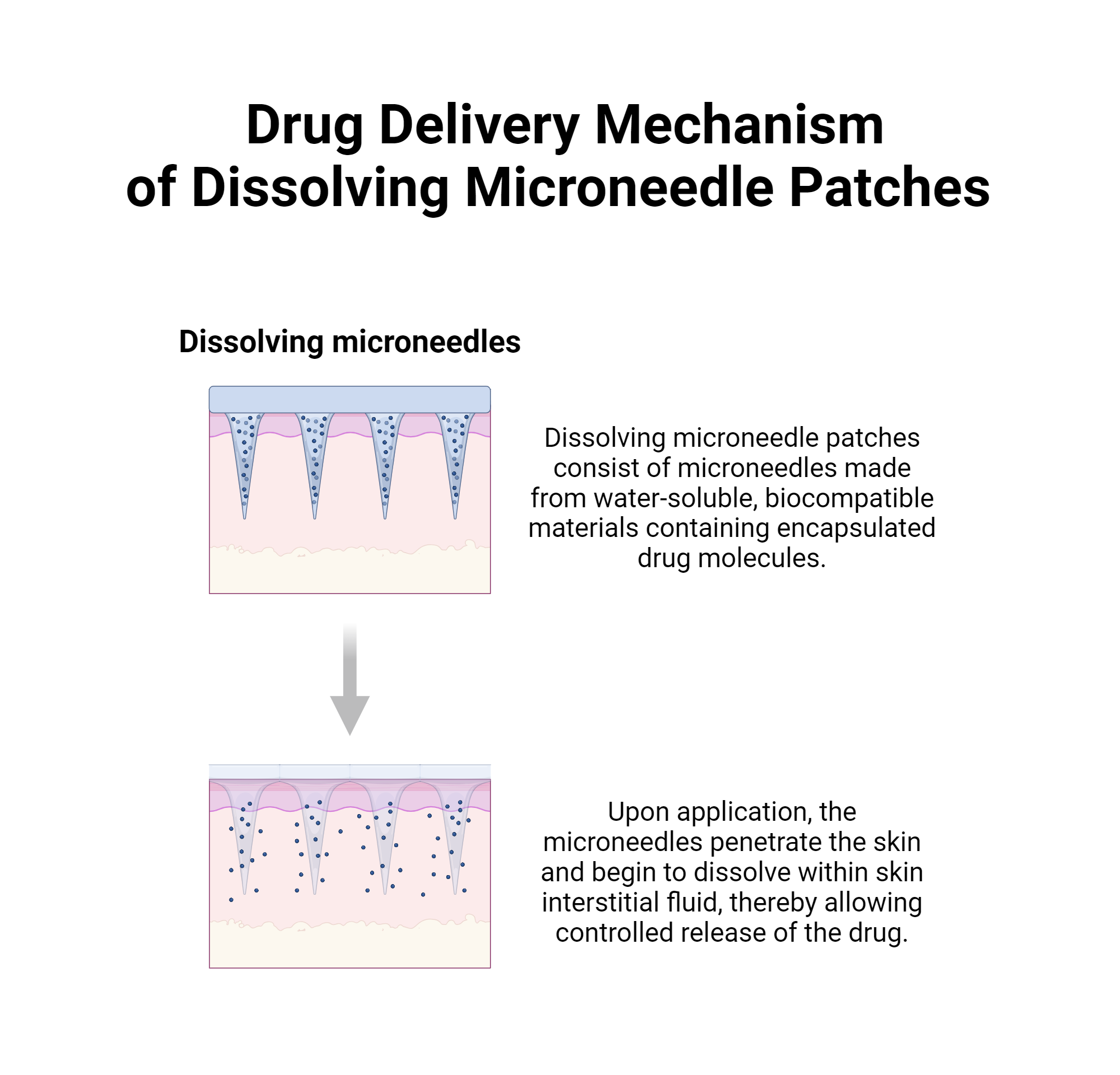Drug Delivery Mechanism of Dissolving Microneedle Patches | BioRender ...
