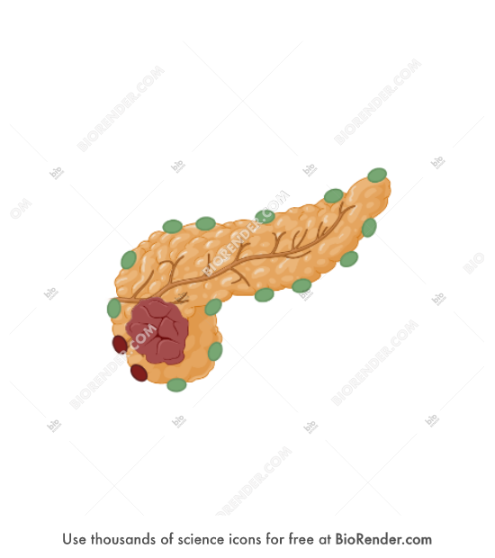 Free Pancreatic tumor (with lymph nodes) Icons, Symbols & Images ...