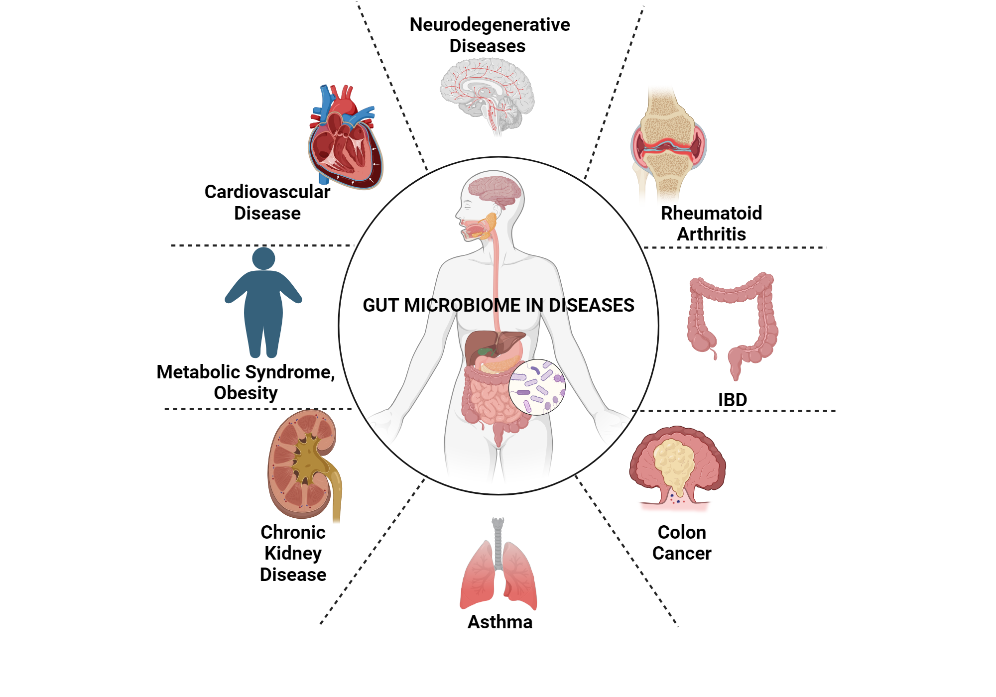 Diseases associated with Gut Microbiome Dysregulation | BioRender ...