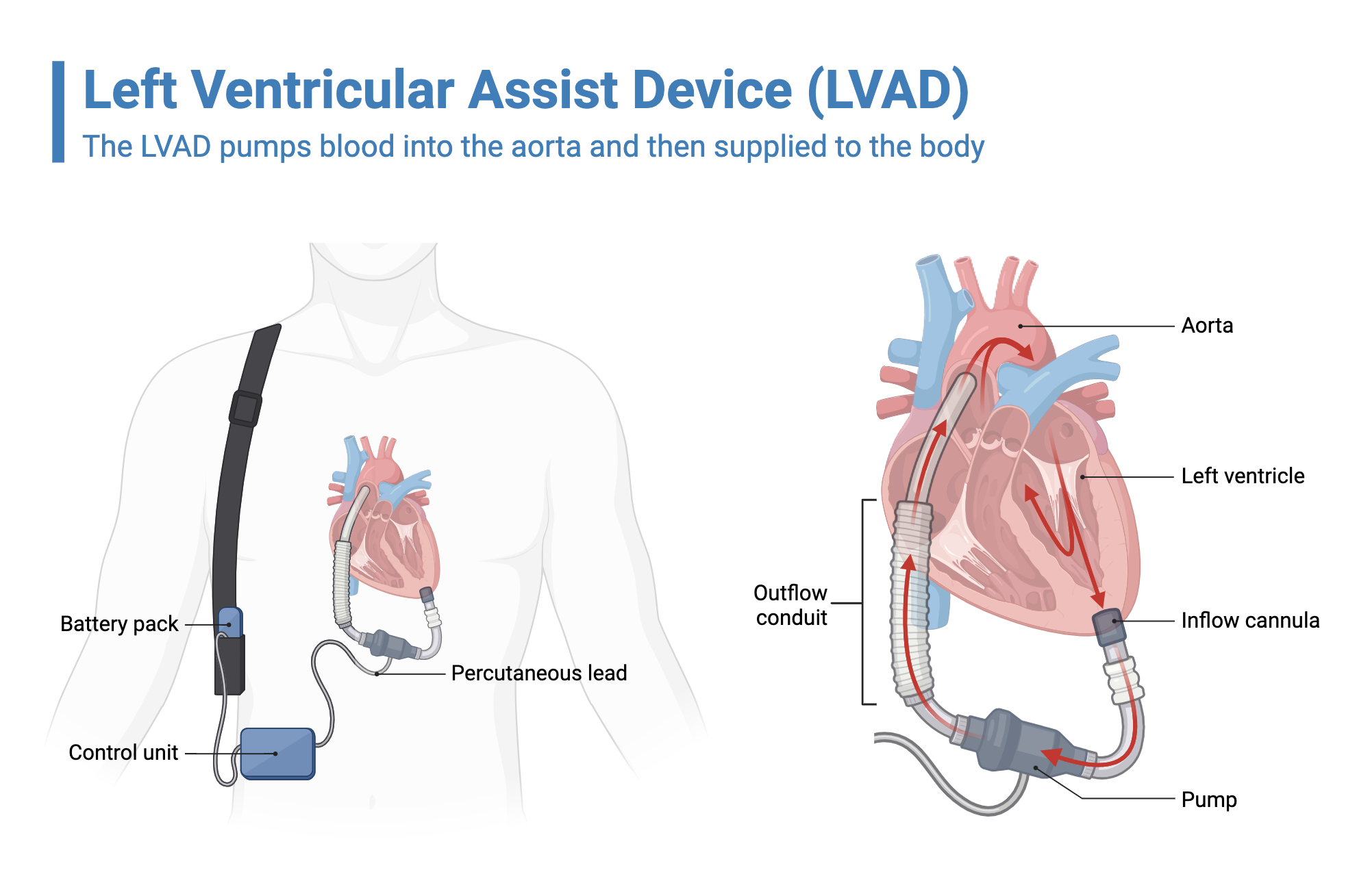 Left Ventricular Assist Device (LVAD) | BioRender Science Templates
