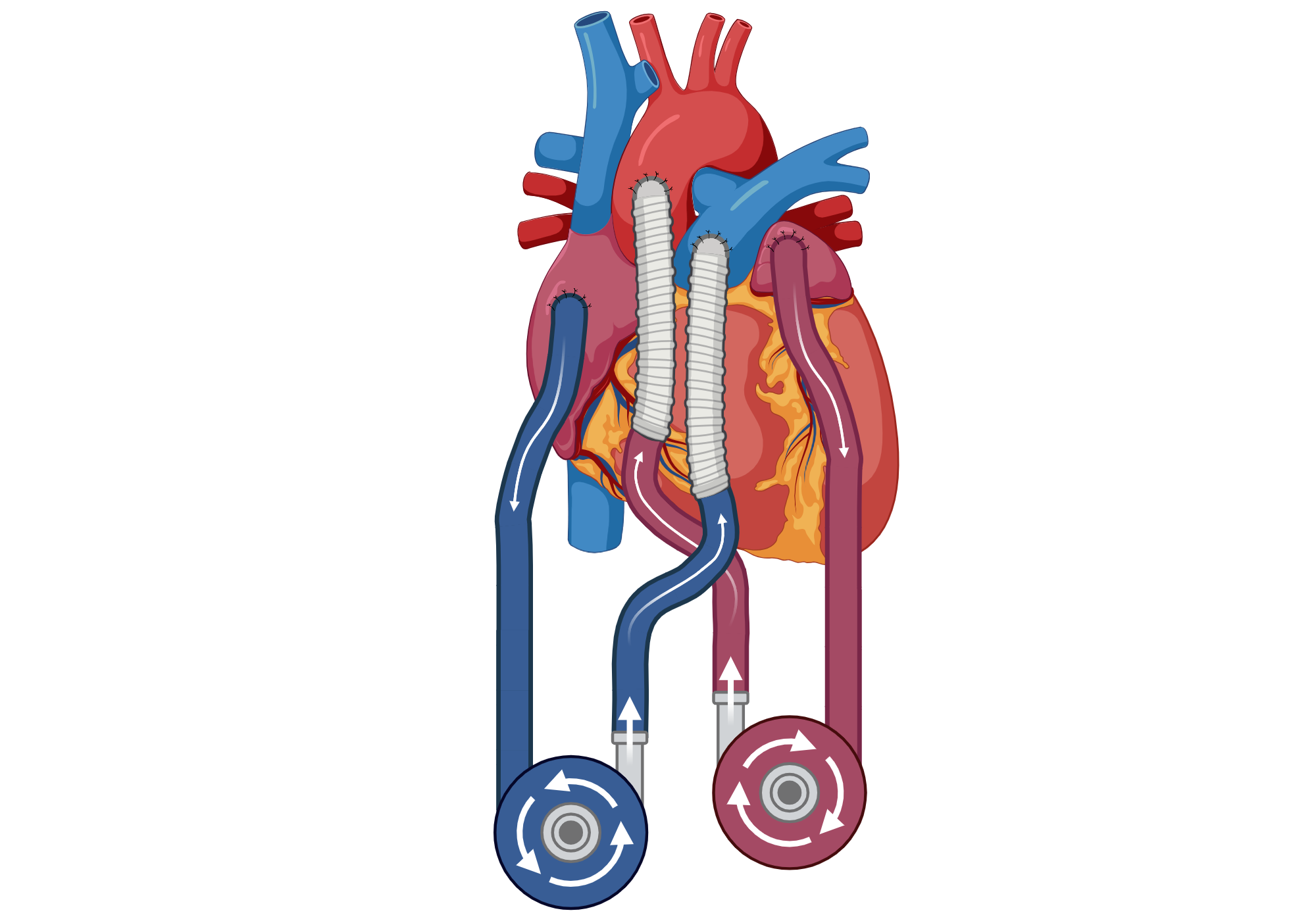 Biventricular assist device (BiVAD) | BioRender Science Templates