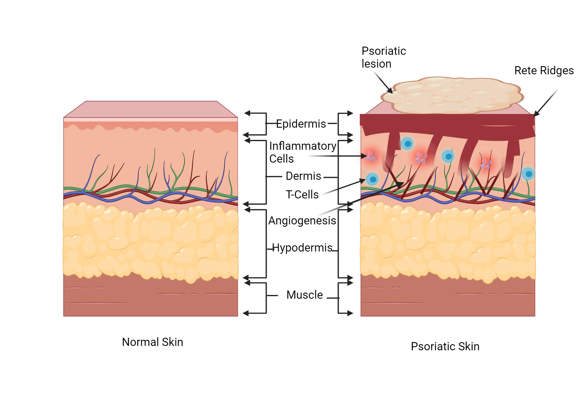 Normal skin and Psoriatic skin | BioRender Science Templates