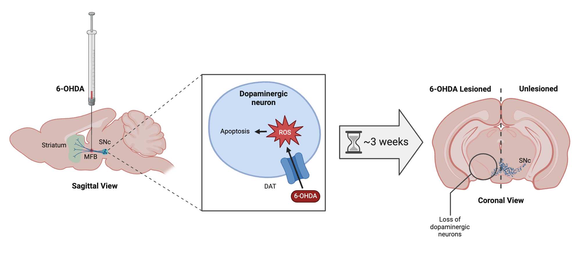 6-hydroxydopamine (6-OHDA) Rodent Model of Parkinson's Disease ...