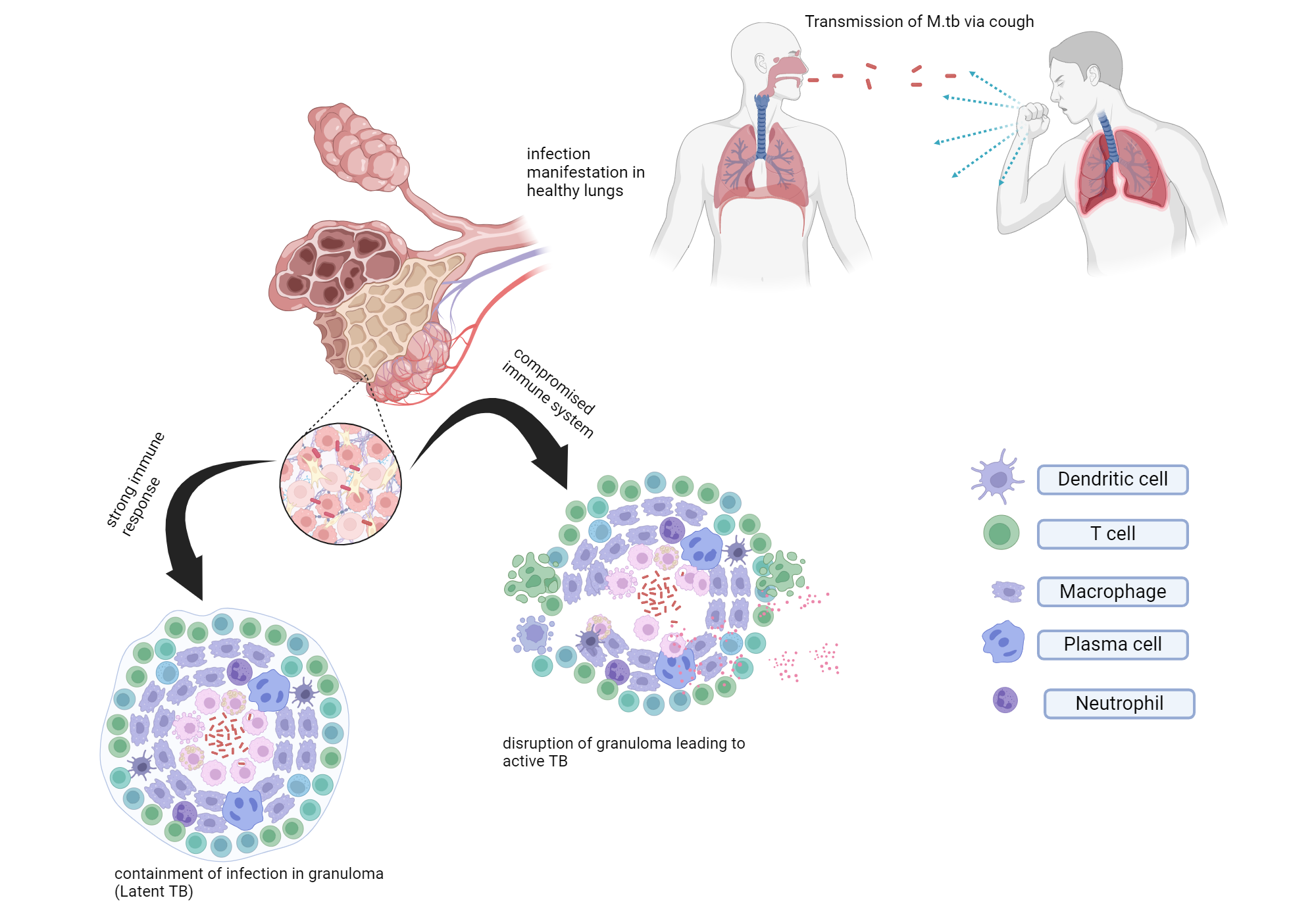 Pathology of pulmonary tuberculosis and role of immune cells ...