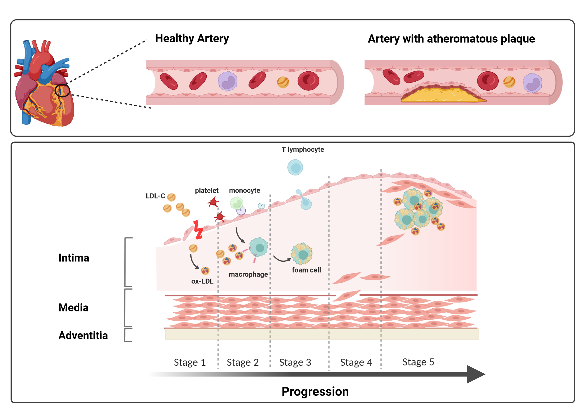 Simplified Demonstration of Atherogenesis Inflammatory Processes ...