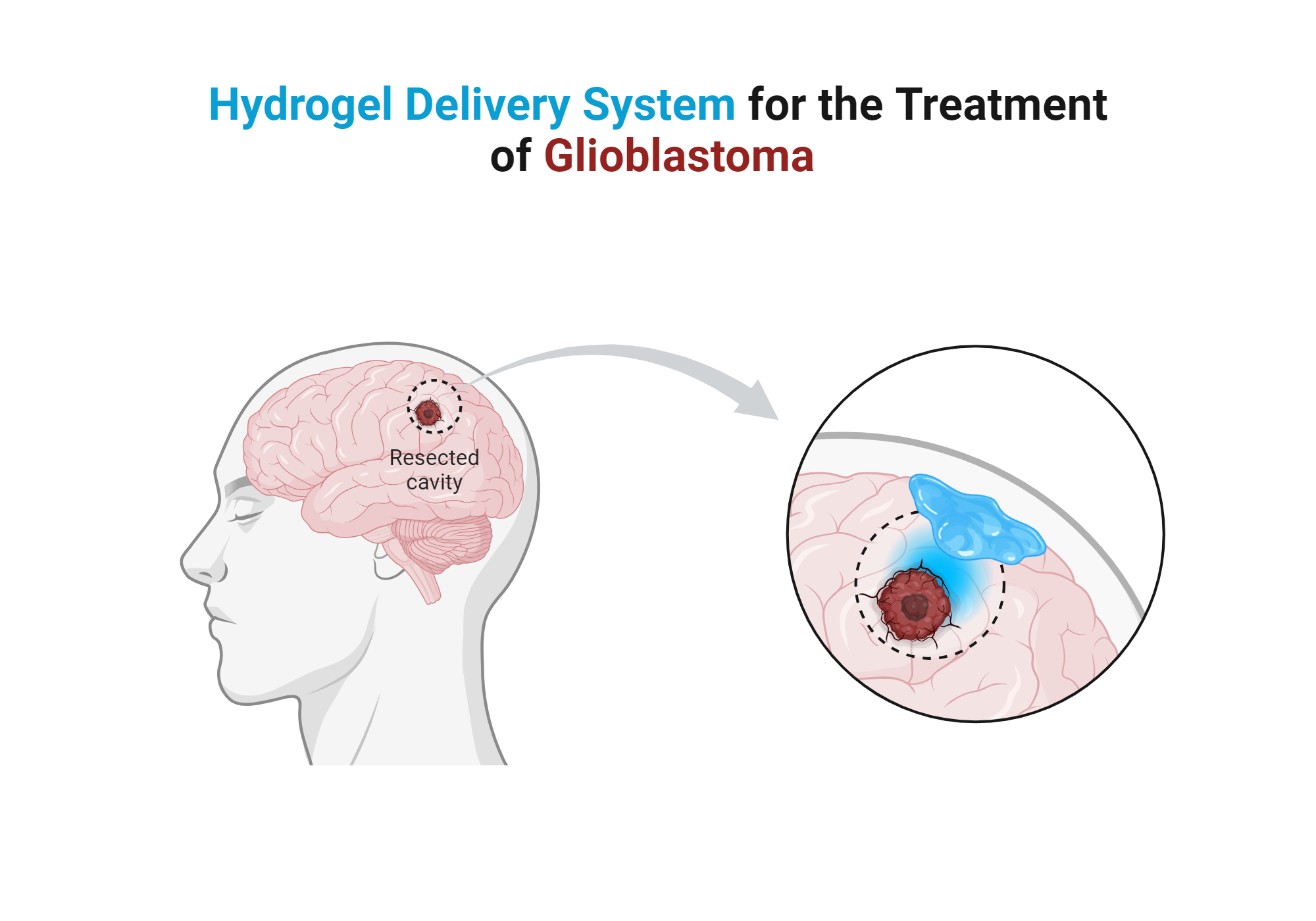 Hydrogels Delivery System for the Treatment of Glioblastoma | BioRender ...