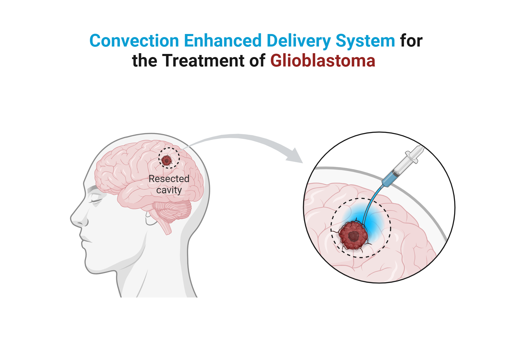 Convection Enhanced Delivery System for the Treatment of Glioblastoma ...
