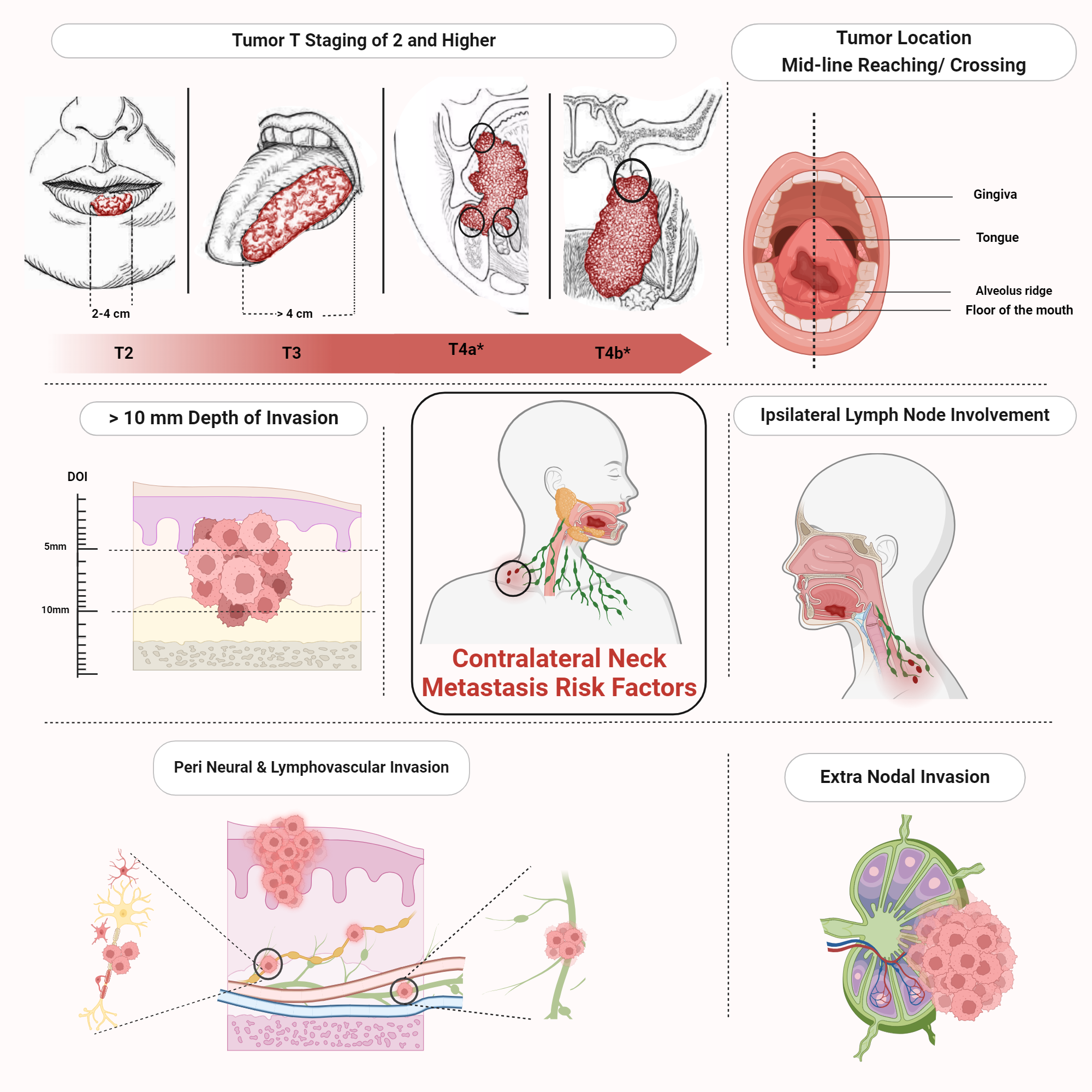 Contralateral Neck Metastasis Risk Factors in OCSCC | BioRender Science ...