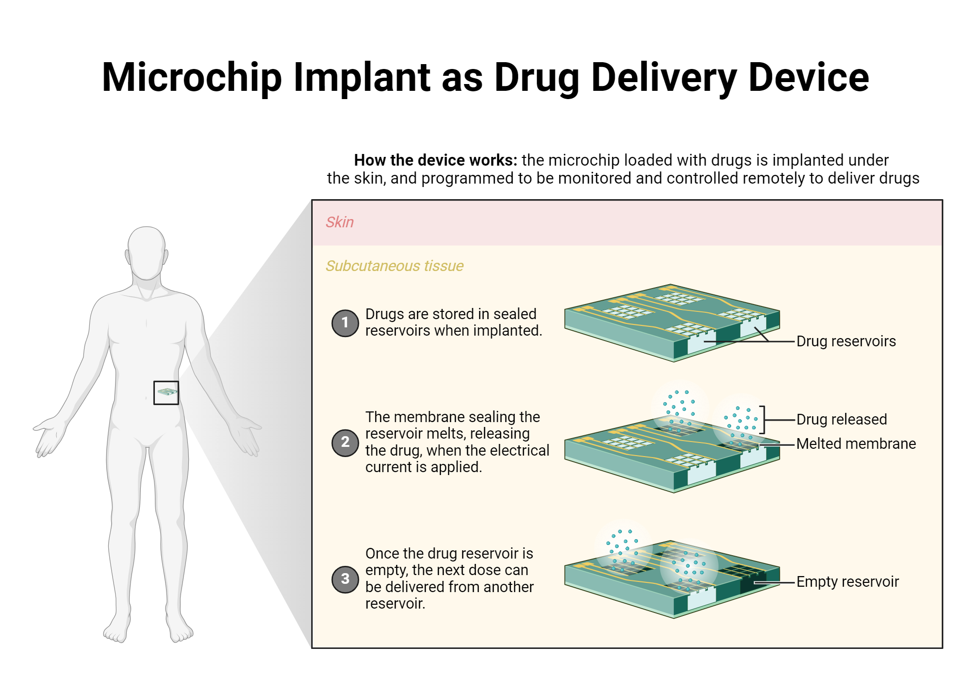 Microchip Implants as Drug Delivery Device | BioRender Science Templates