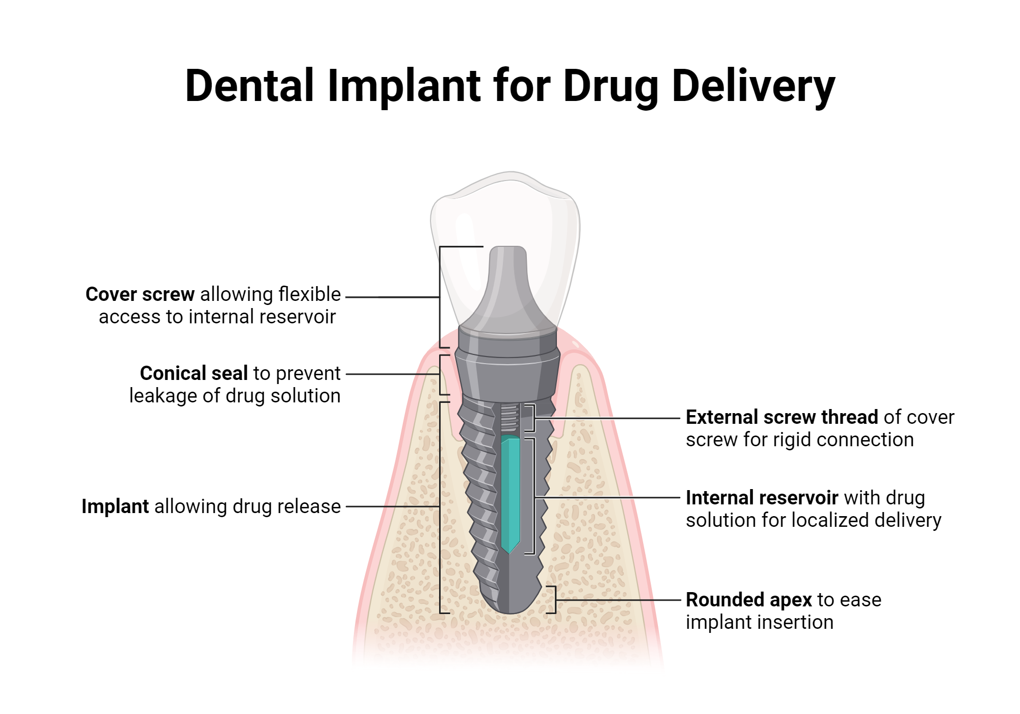 Dental Implant for Drug Delivery | BioRender Science Templates