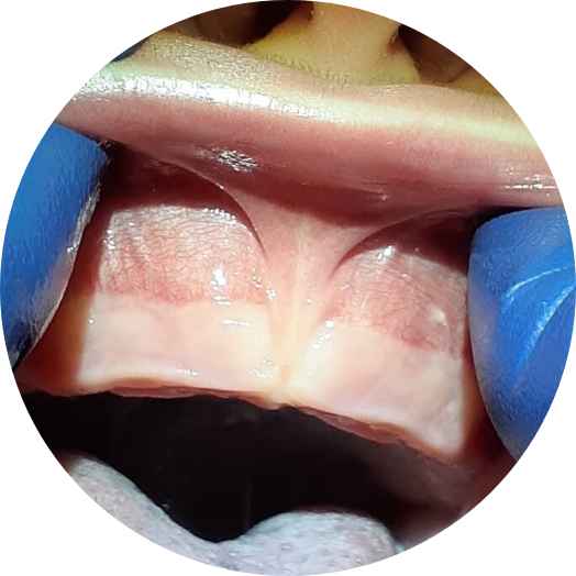 Cusp Untethered, Tongue-Tie Surgery, Frenectomy in Virginia Beach