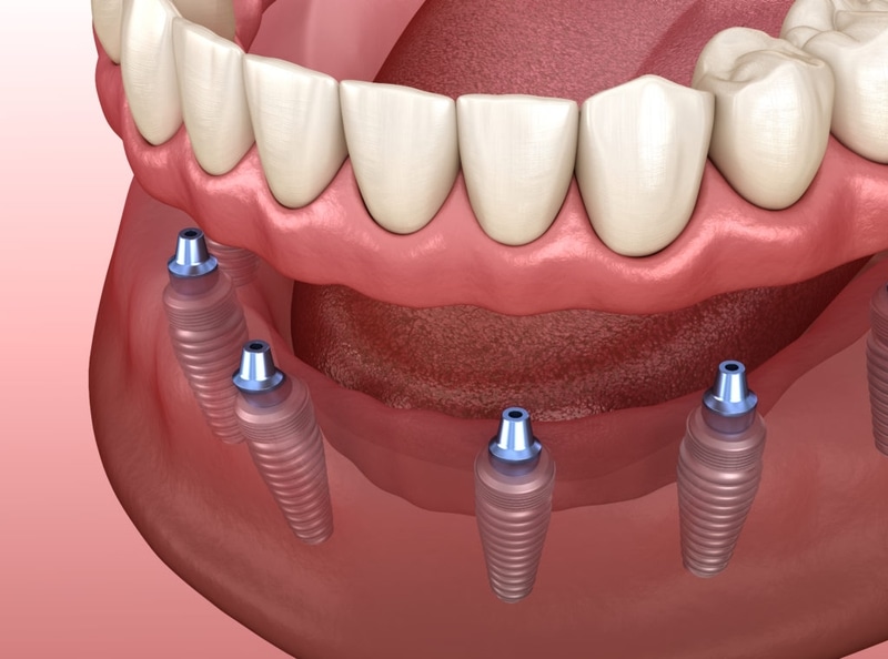 Implant Supported Dentures in North Carolina | Riccobene Associates