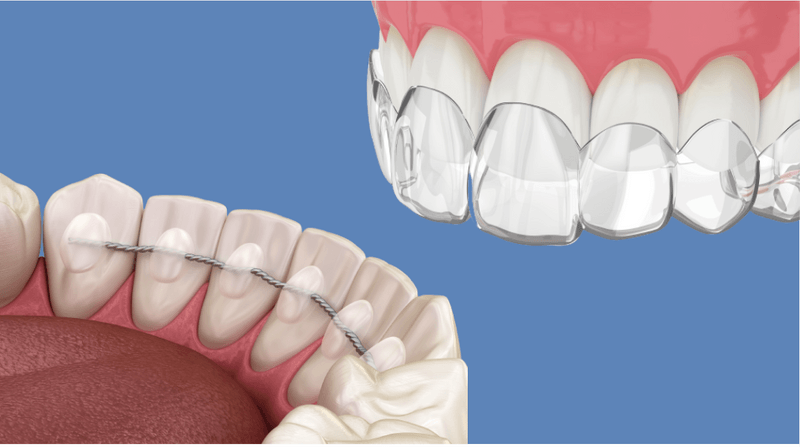 RETAINERS: The Whys & Whats | Blog